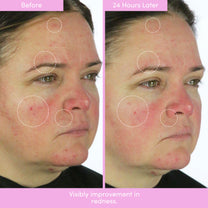 Lion Pose - PEP TALK™ Skin Barrier Repair Cream for Post-Acne Dark ...